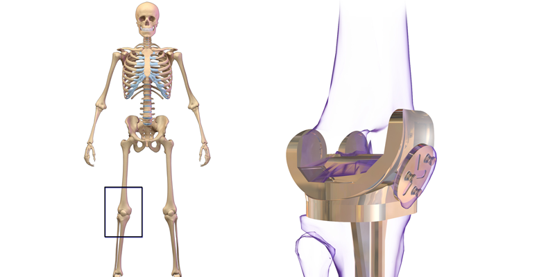 What Is a Total Knee Replacement? - Capital Area PT & Wellness